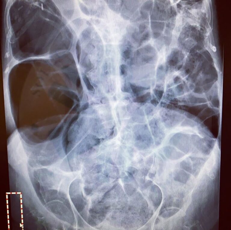 Caso Clínico: Obstrucción Intestinal – Blog
